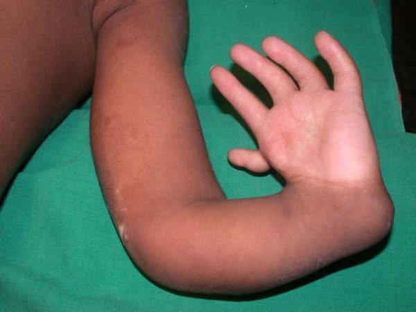 Radial Club Hand | Hand2Shoulder Clinic