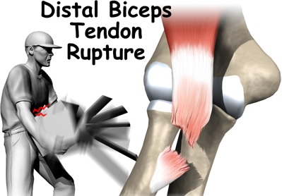 Distal Biceps Tendon Tear | Hand2Shoulder Clinic