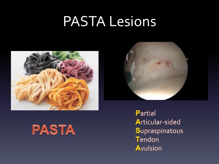 PASTA Lesion and Repair | Hand2Shoulder Clinic