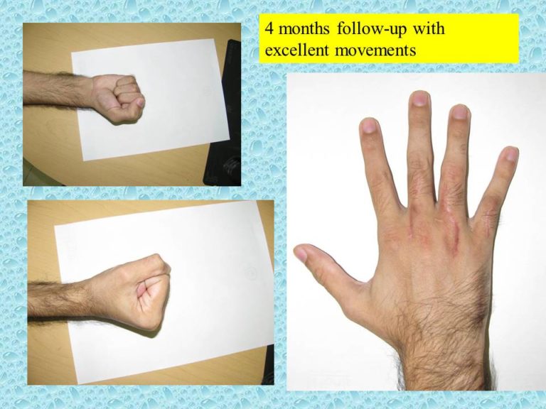 Treating Hand Fractures | Hand2Shoulder Clinic