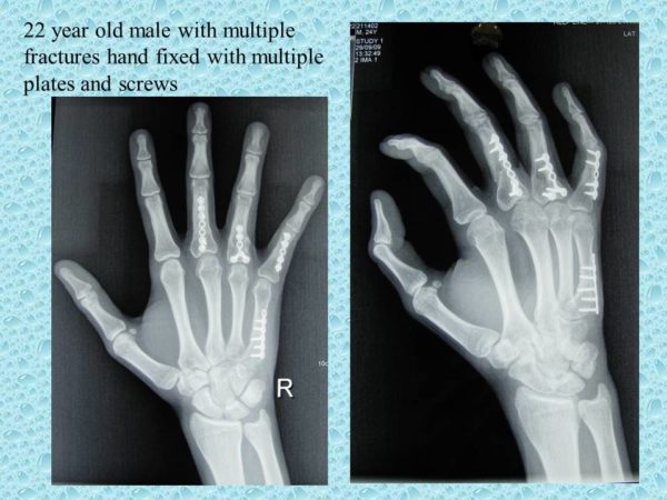 Treating Hand Fractures | Hand2Shoulder Clinic
